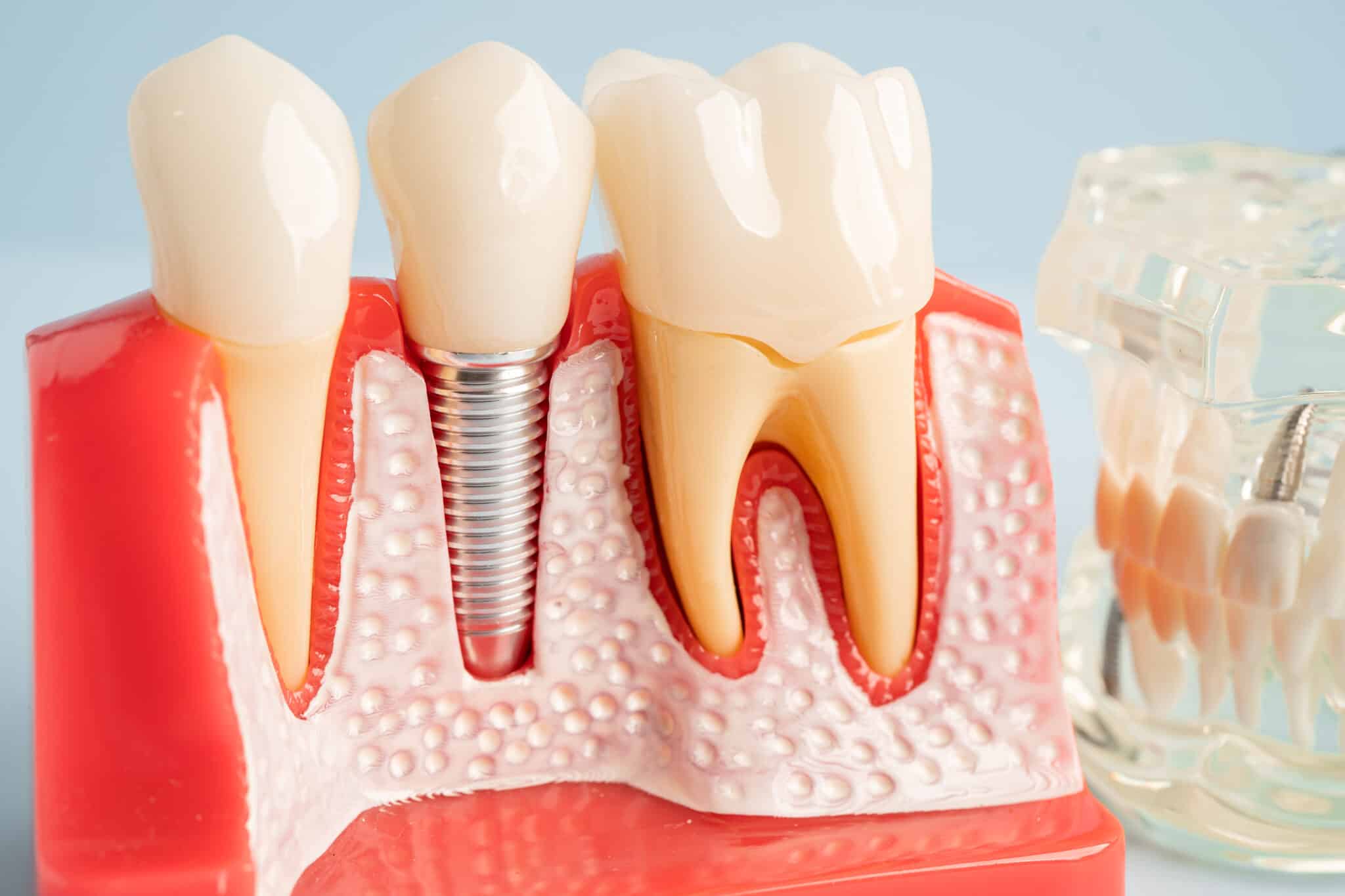 Dental Implants – Legacy Dental Co.